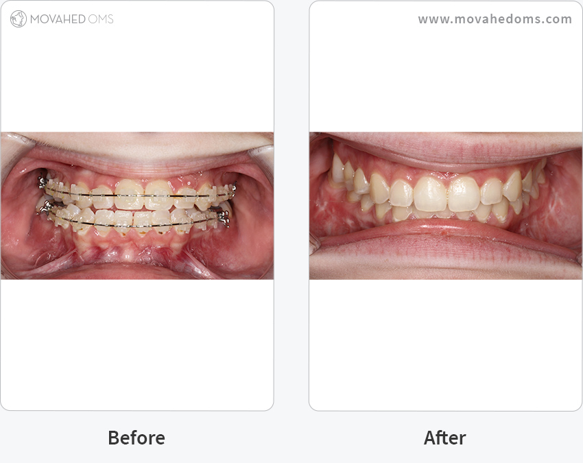 Facial Asymmetry | Before & After Case Study | Movahed OMS | St. Louis