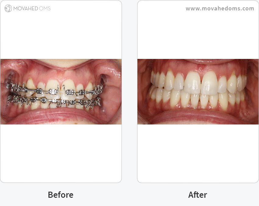 Case Study | Combined Total Joint Replacement with Orthognathic Surgery