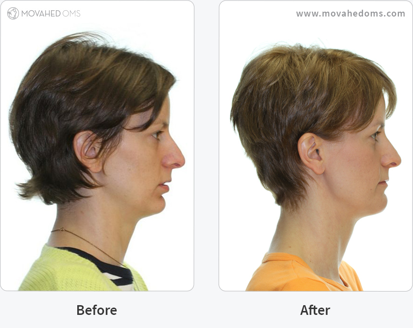 Case Study | Combined Total Joint Replacement with Orthognathic Surgery