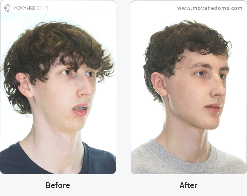 Combined Total Joint Replacement With Orthognathic Surgery Case Study