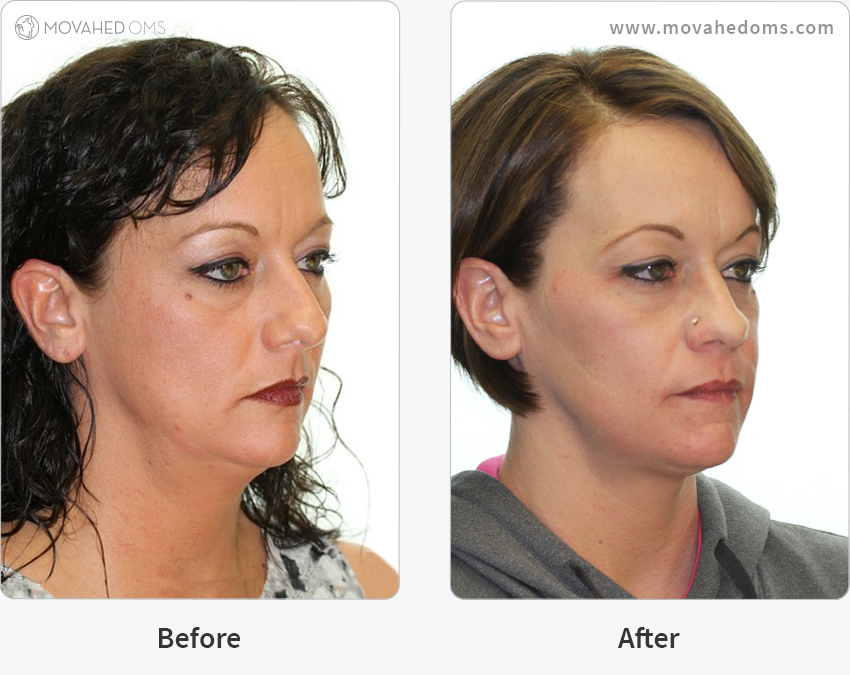 Case Study For Obstructive Sleep Apnea | Movahed OMS | St. Louis, MO