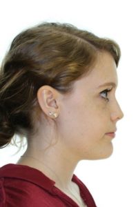young-blonde-woman-after-corrective-jaw-surgery-off-side-profile-400× ...