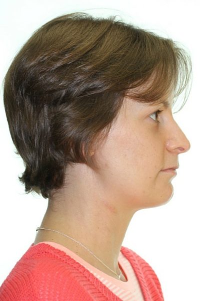 young-brunette-woman-after-temporomandibular-joint-tmj-surgery-side ...